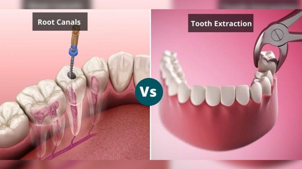 Root Canal vs Extraction – Pros, Cons & Cost Comparison